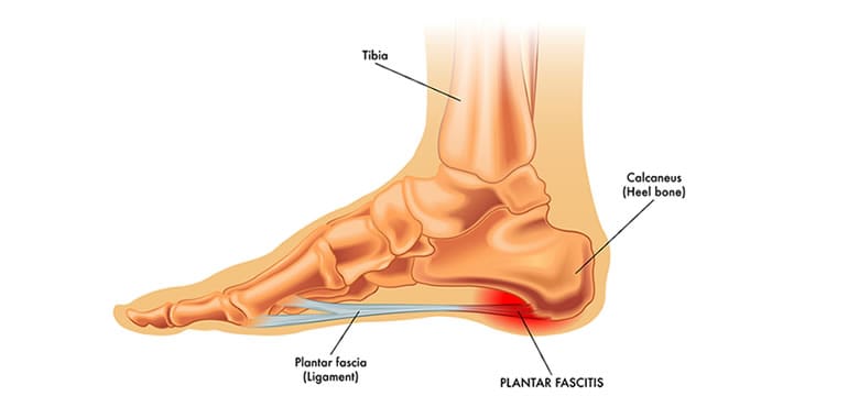 Physical Therapy for Plantar Fasciitis - Heal Foot Pain - PRO Therapy